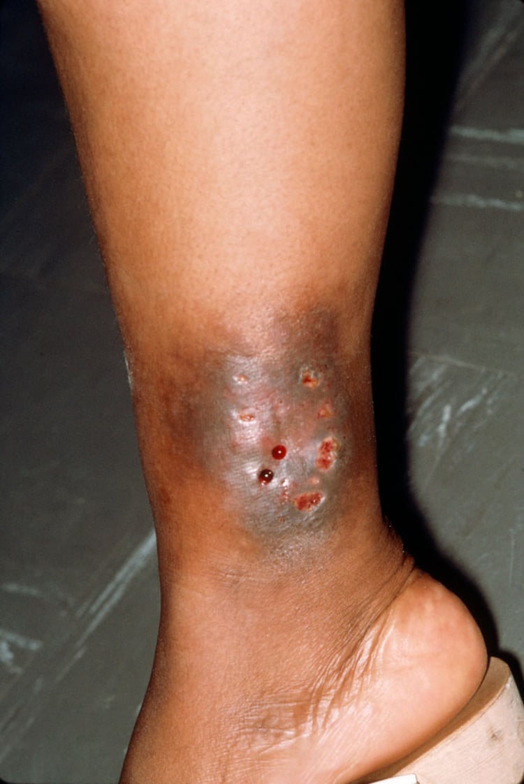 Syphilis - Infectious Diseases - MSD Manual Professional Edition
