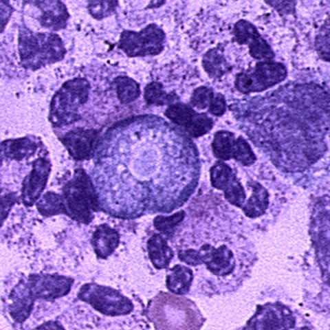 Primary Amebic Meningoencephalitis - Infectious Disease - MSD Manual ...