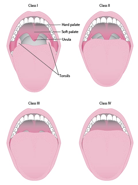 Snoring - Snoring - MSD Manual Professional Edition