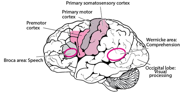 Overview of Stroke - Neurologic Disorders - MSD Manual Professional Edition