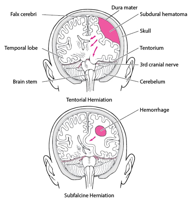 Brain Herniation - Neurologic Disorders - MSD Manual Professional Edition