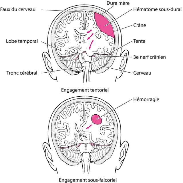 Engagement cérébral - Troubles neurologiques - Édition professionnelle ...