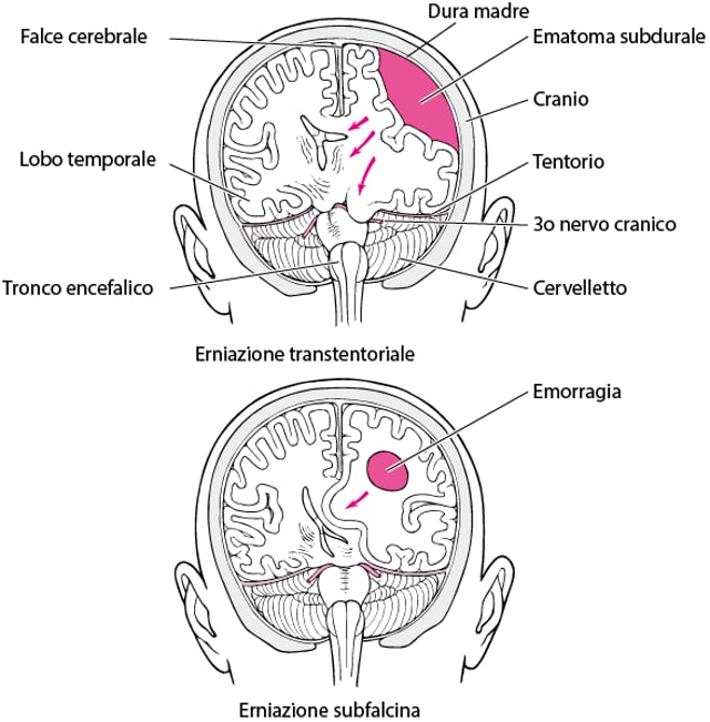 Ernia cerebrale - Malattie neurologiche - Manuali MSD Edizione ...