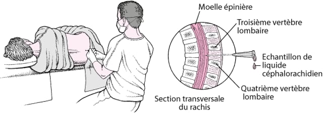 Image:Ponction lombaire-Édition professionnelle du Manuel MSD
