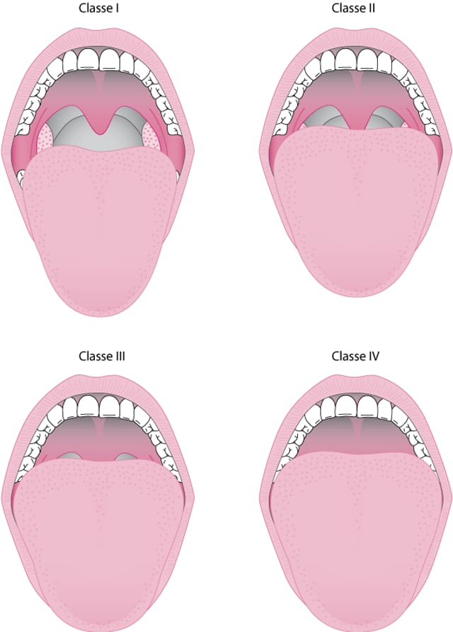 Image:Score de Mallampati modifié-Édition professionnelle du Manuel MSD