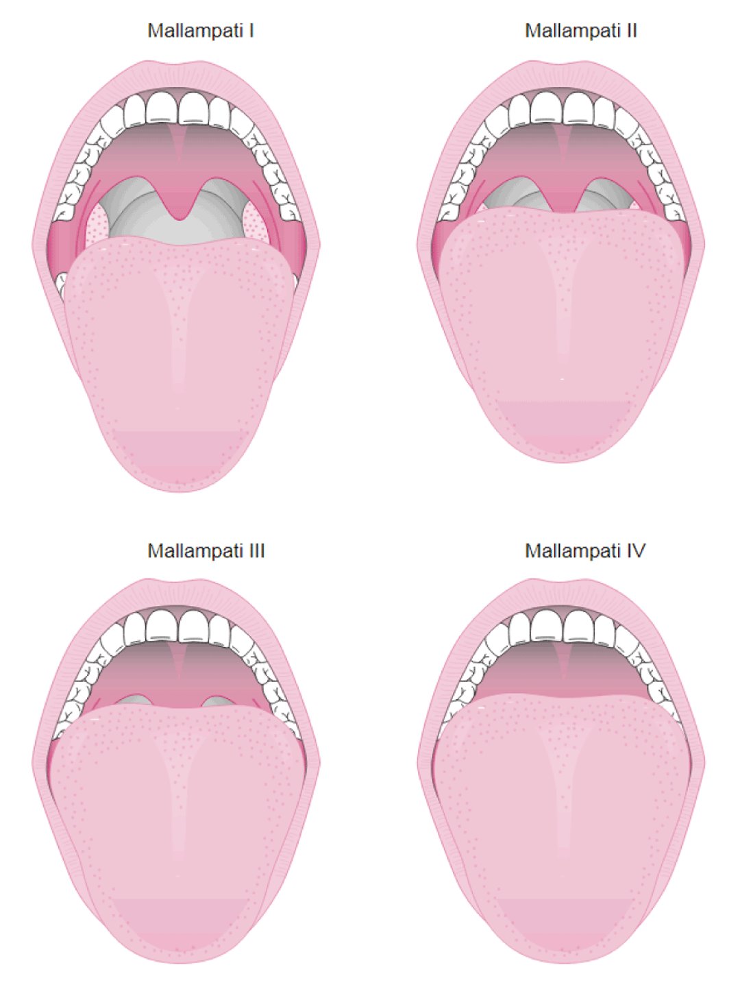 Image:Pontuação modificada de Mallampati-Manuais MSD edição para ...