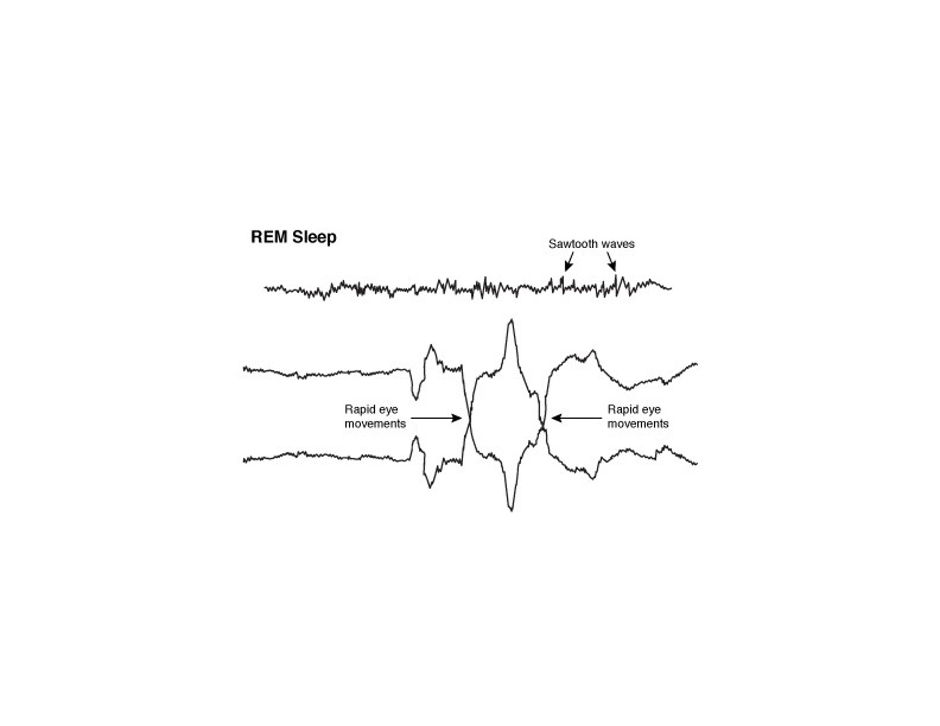 Image:Rapid eye movement (REM) EEG-Merck Manual Professional Edition