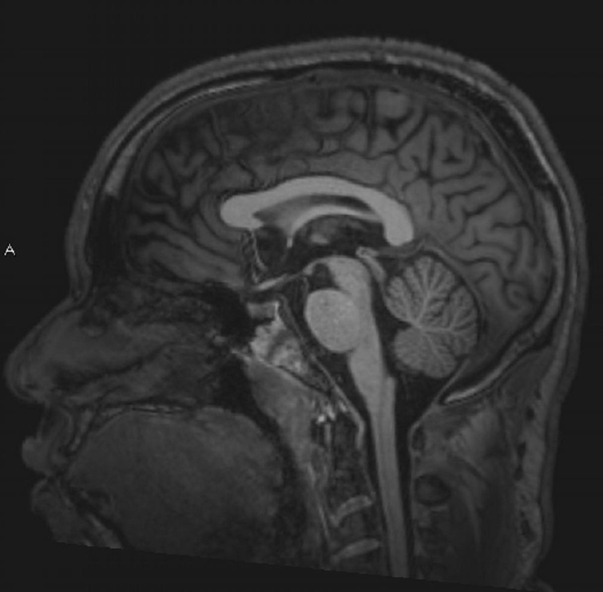 Image:RM cerebral normal (sagital)–diapositiva 4-Manual MSD versión ...