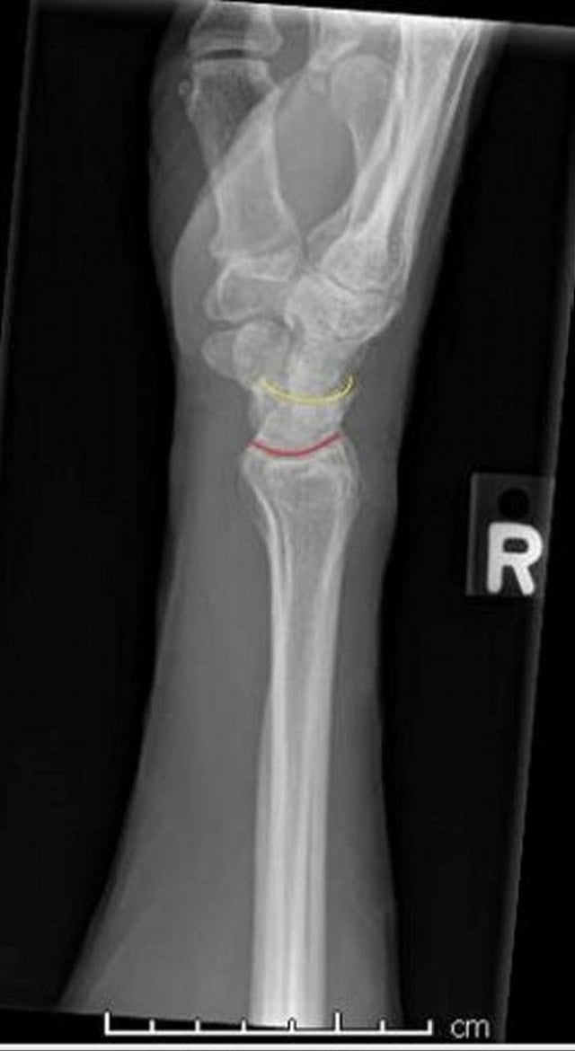 Image:Normal Wrist: Lateral View-Merck Manual Professional Edition