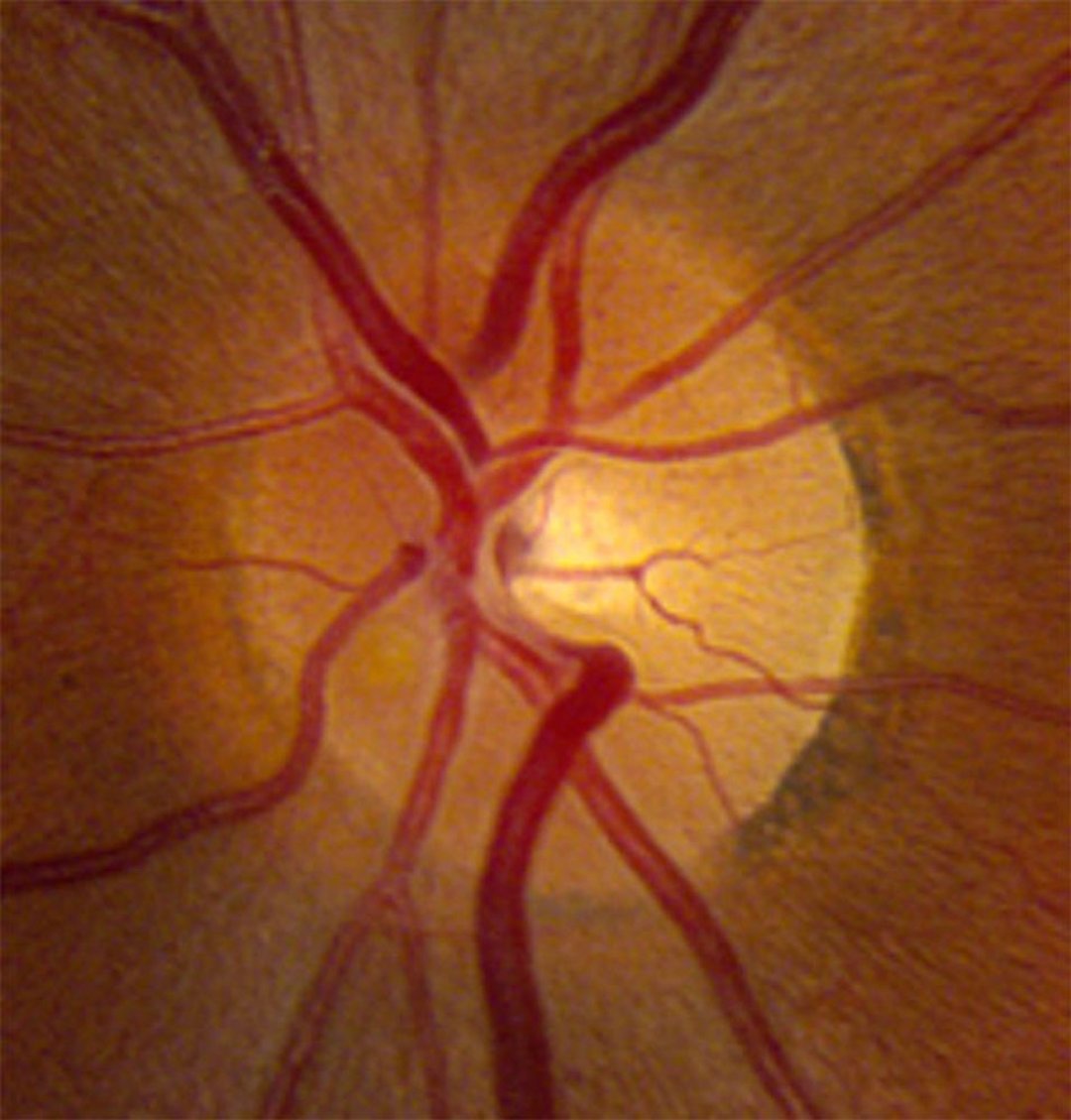 Glaucoma primário de ângulo aberto - Distúrbios oftalmológicos ...
