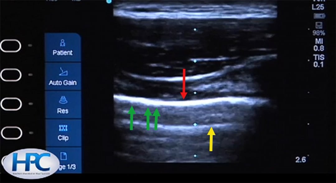 Image:Normal Pleural Line-Merck Manual Professional Edition