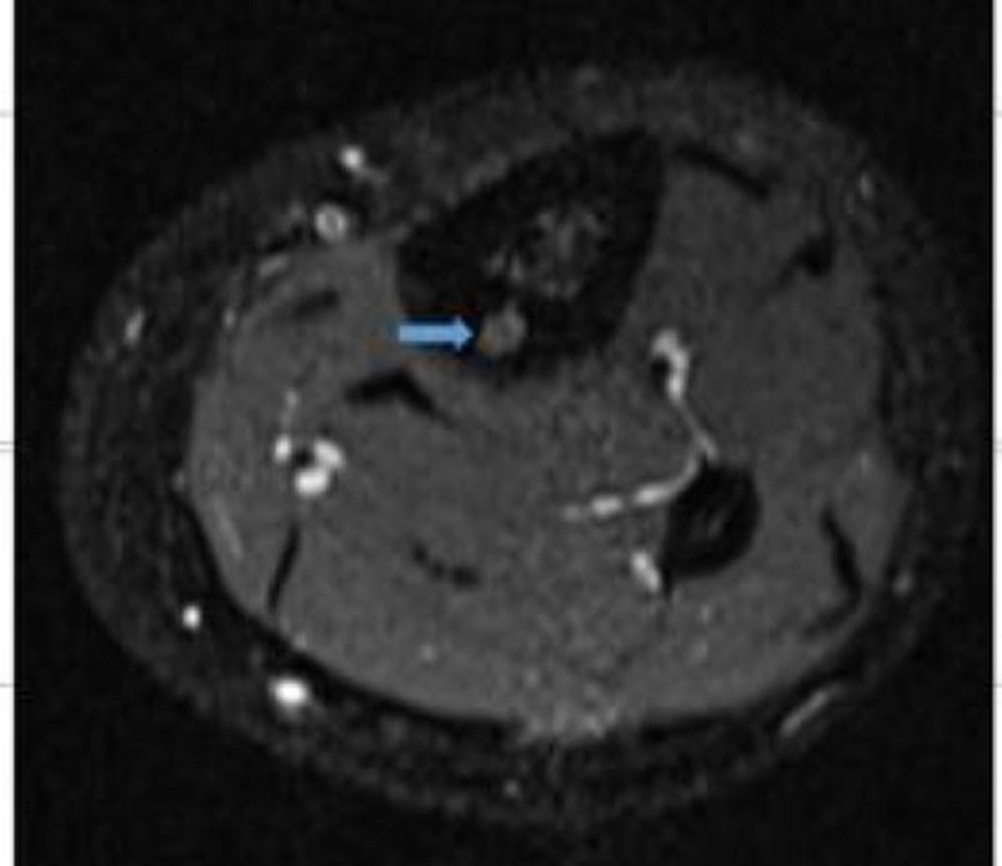 Image:U xương dạng xương ở xương chày (chụp MRI)-Cẩm nang MSD - Phiên bản dành cho chuyên gia