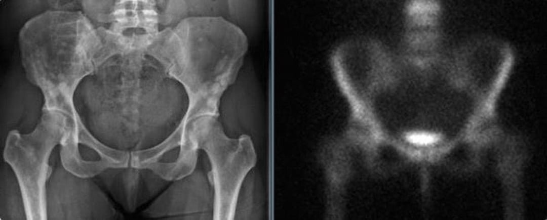 Benign Bone Tumors and Cysts - Musculoskeletal and Connective Tissue ...