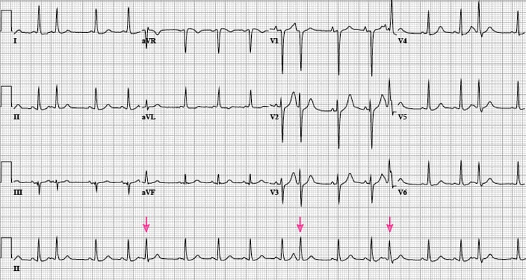 Image:Sinus Rhythm With Atrial Premature Beats (Arrows)-Merck Manual ...