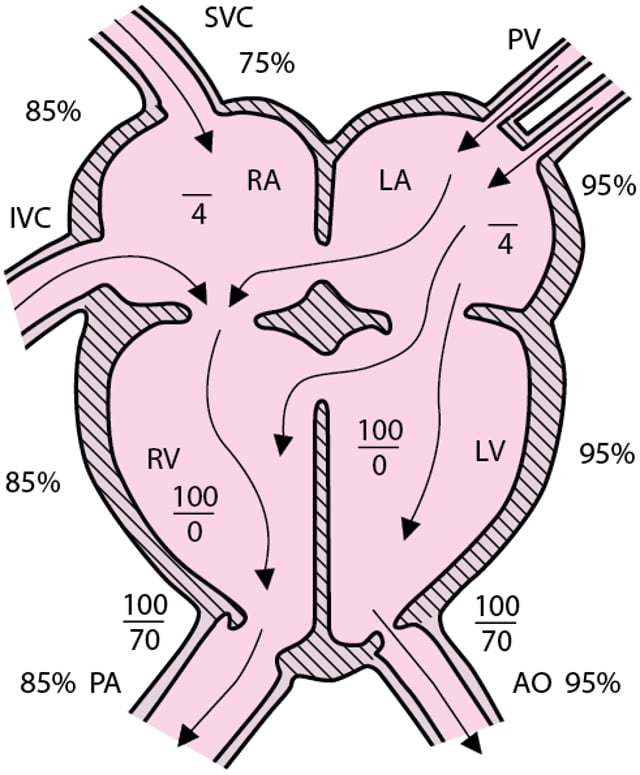 Image:Atrioventricular septal defect (complete form)-Merck Manual ...