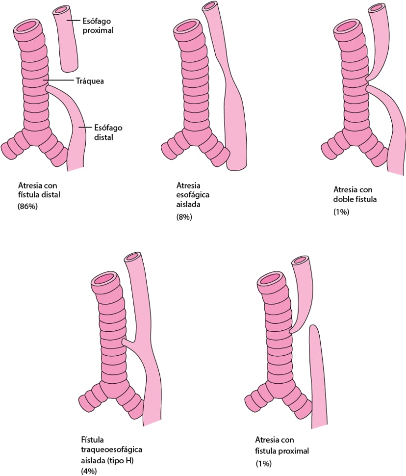 Atresia esofágica - Pediatría - Manual MSD versión para profesionales