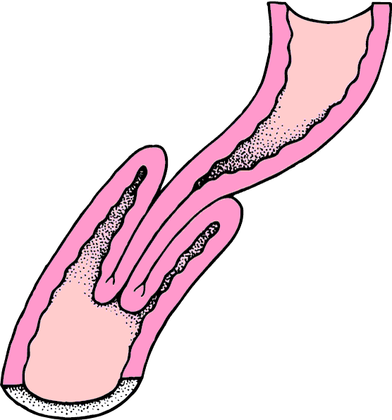 Intussusception - Pediatrics - MSD Manual Professional Edition