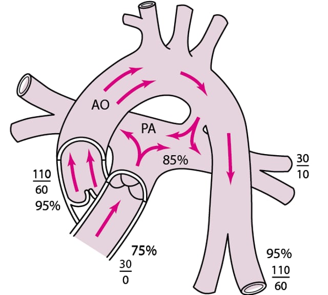 Patent Ductus Arteriosus (PDA) - Pediatrics - Merck Manual Professional ...
