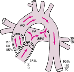 動脈管開存症（PDA） - 動脈管開存症（PDA） - MSDマニュアル プロフェッショナル版