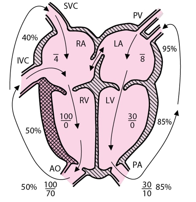 Transposition of the Great Arteries (TGA) - Transposition of the Great ...