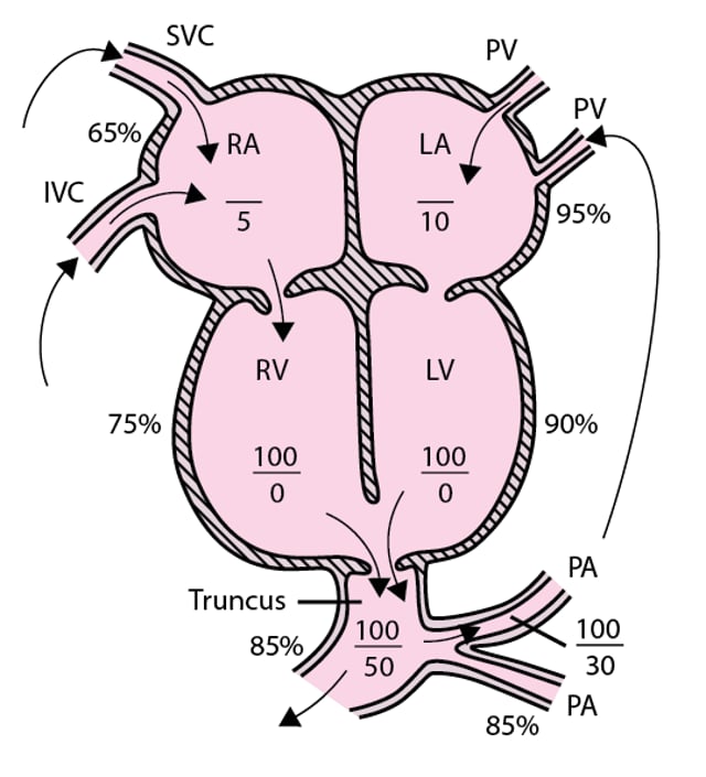 Persistent Truncus Arteriosus - Pediatrics - MSD Manual Professional ...