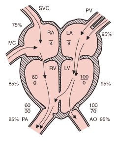 Ventricular Septal Defect (VSD) - Pediatrics - MSD Manual Professional ...