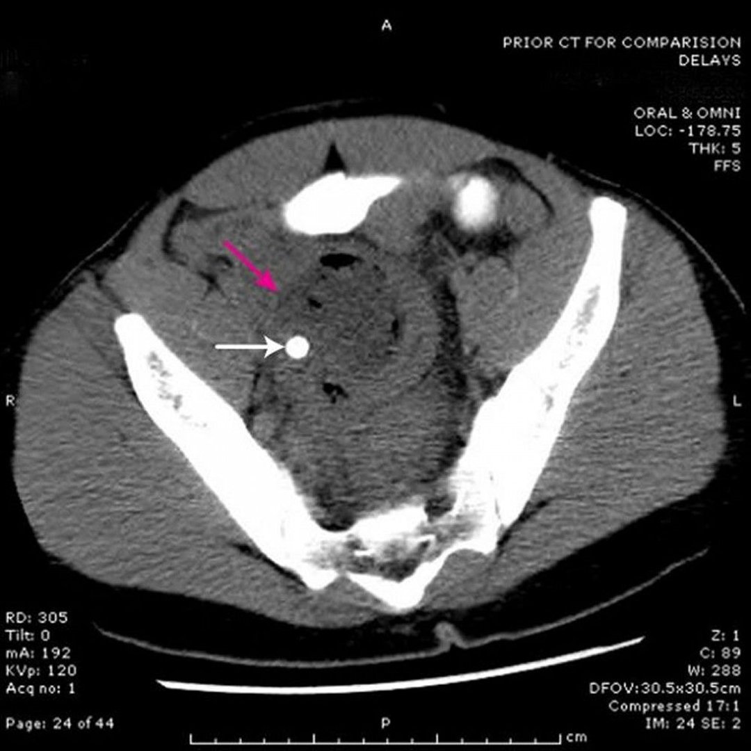 Image:Pelvic Abscess (CT Scan)-MSD Manual Professional Edition