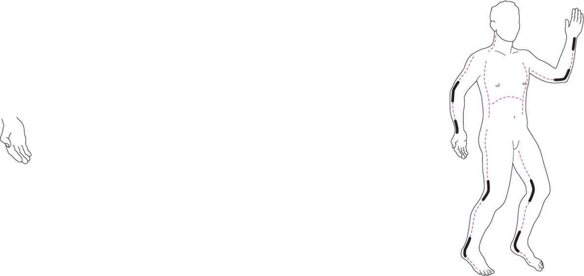 Як виконувати есхаротомію при опіках - Як виконувати есхаротомію при ...