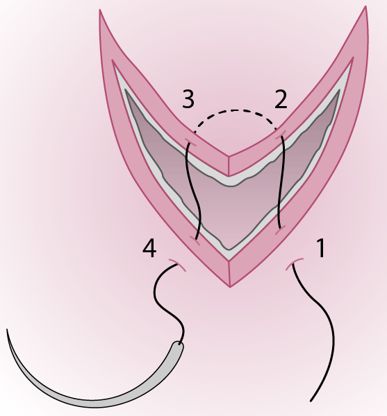 Image:Half-Buried Horizontal Mattress Suture-MSD Manual Professional ...