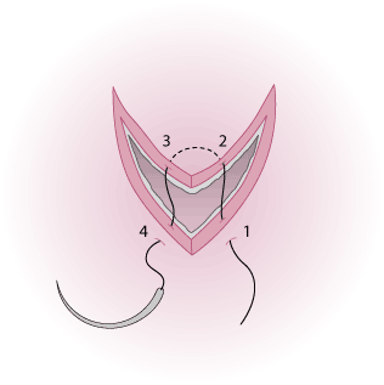 Image:Пластика клаптя рваної рани-MSD Manual Professional Edition