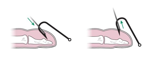 How To Remove a Shallow Fishhook - Injuries; Poisoning - Merck Manual ...