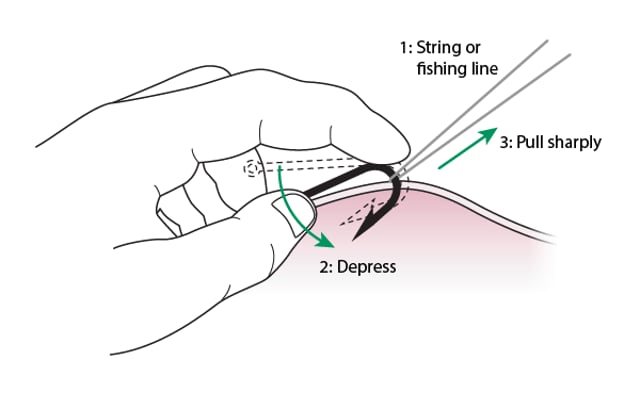 Image:Fish hook removal: String method-Merck Manual Professional Edition