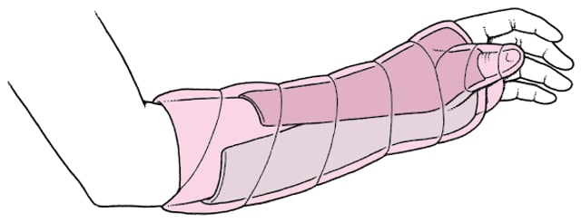 母指副子（thumb spica splint）の装着 - 22. 外傷と中毒 - MSDマニュアル プロフェッショナル版