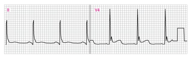 Image:Abnormal ECG showing J (Osborn) waves (V4)-MSD Manual ...