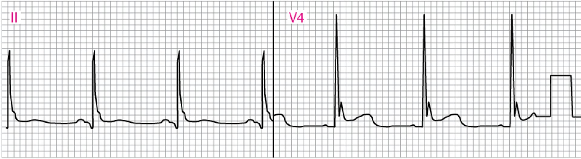 Image:El ECG anormal muestra ondas J (Osborn) (V4)-Manual MSD versión para profesionales
