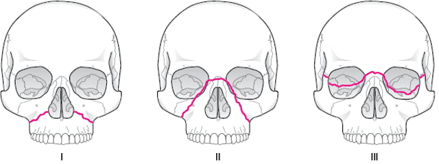 Image:Le Fort Classification of Midface Fractures-Merck Manual ...