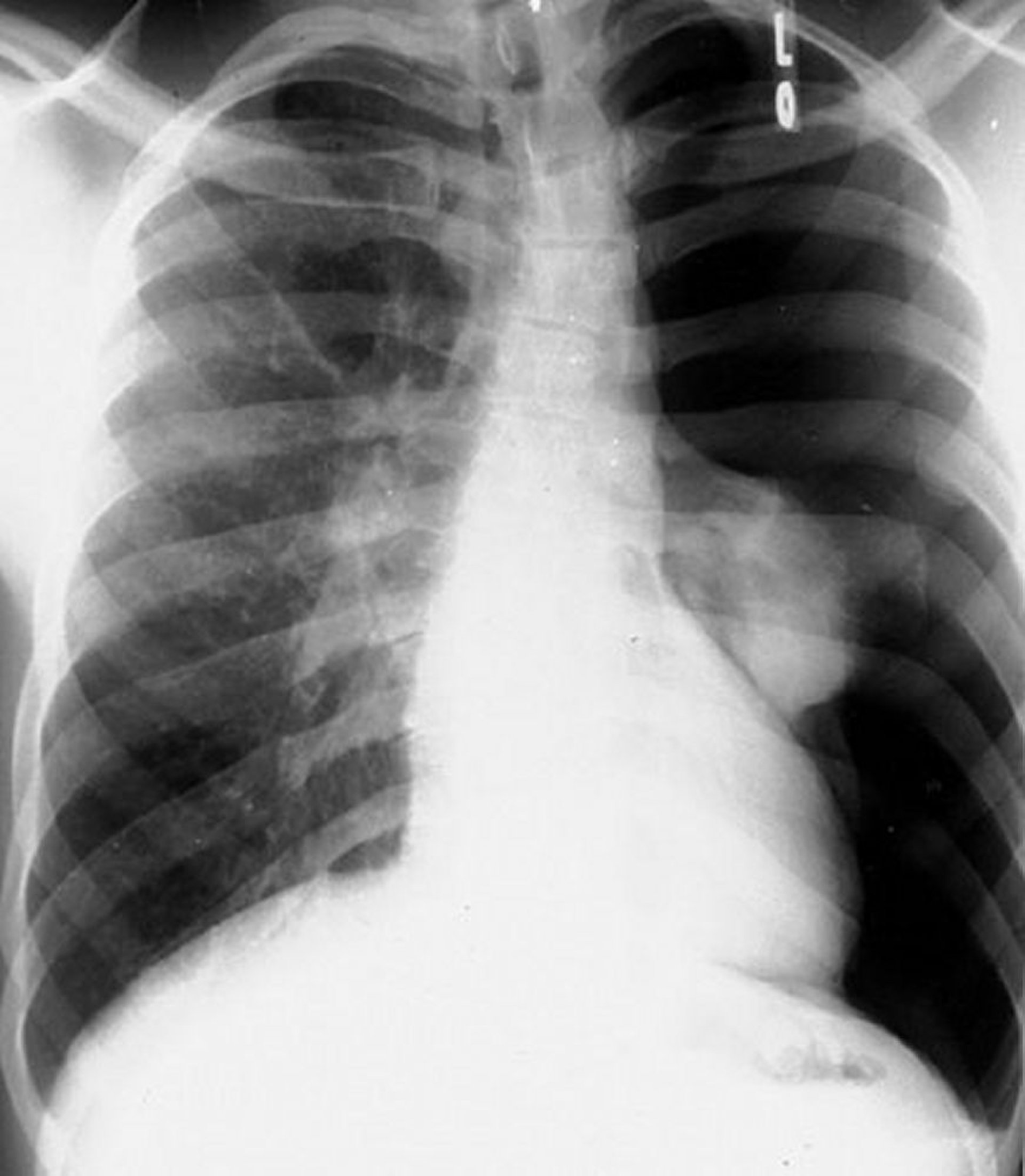 Image:Large Pneumothorax-MSD Manual Professional Edition