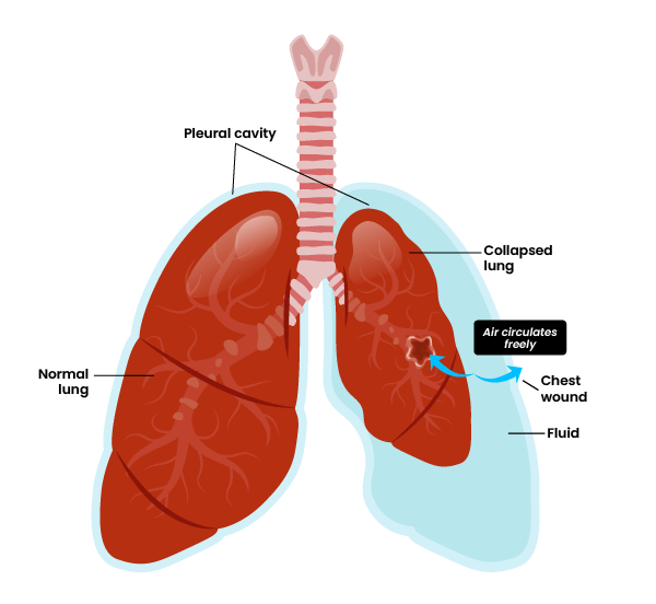 Open Pneumothorax - Injuries; Poisoning - MSD Manual Professional Edition