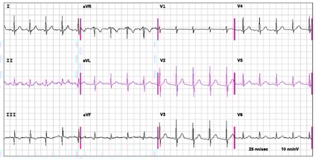 Image:An ECG in Pulmonary Embolism-Merck Manual Professional Edition