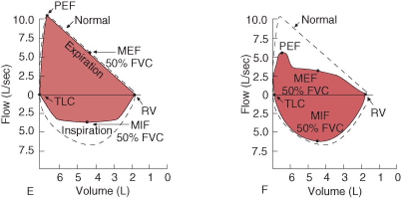 Image:Flow-volume loops-MSD Manual Professional Edition