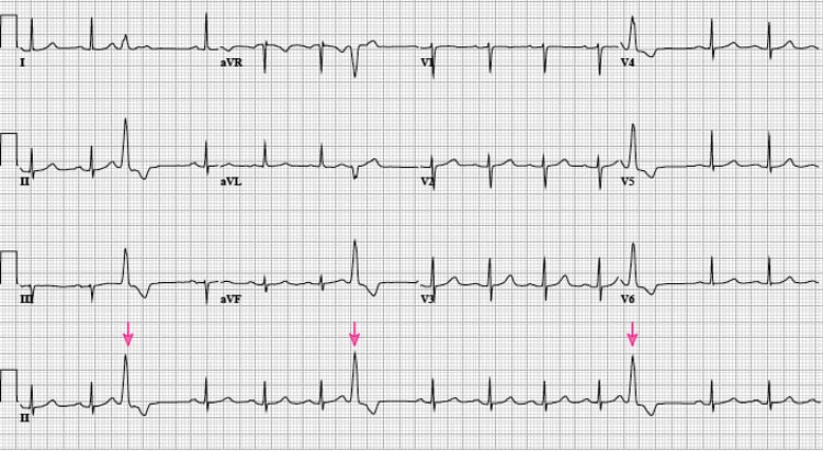 Extrasystoles ventriculaires - Extrasystoles ventriculaires - Édition ...