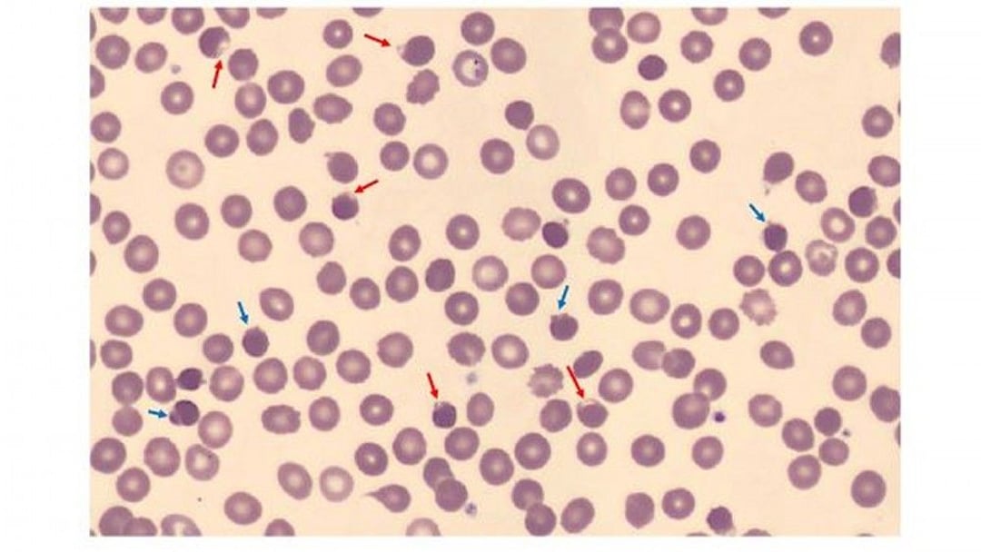 Glucose-6-Phosphate Dehydrogenase (G6PD) Deficiency - Hematology and ...