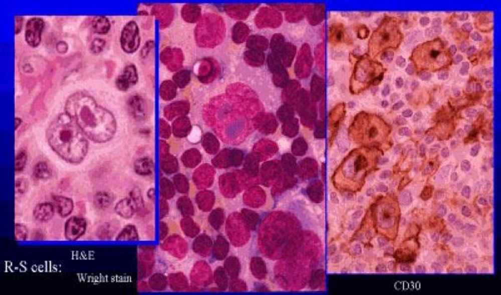 Hodgkin Lymphoma - Oncology - Merck Manual Professional Edition