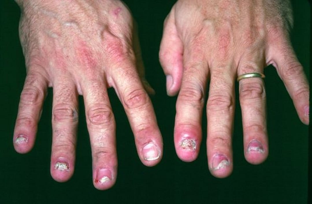 Image:Reactive Arthritis (Nails)-MSD Manual Professional Edition
