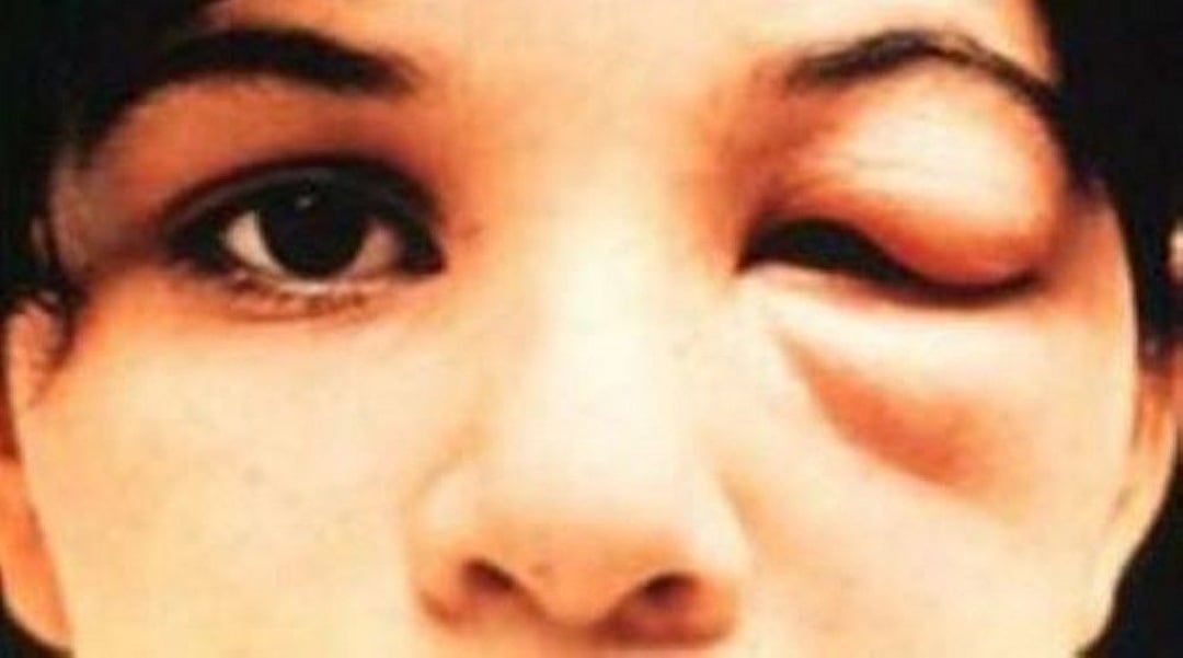 Chagas Disease - Infectious Diseases - Merck Manual Professional Edition