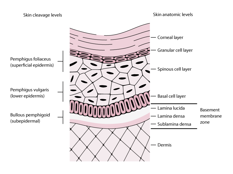 Pemphigoïde bulleuse - Troubles dermatologiques - Édition ...