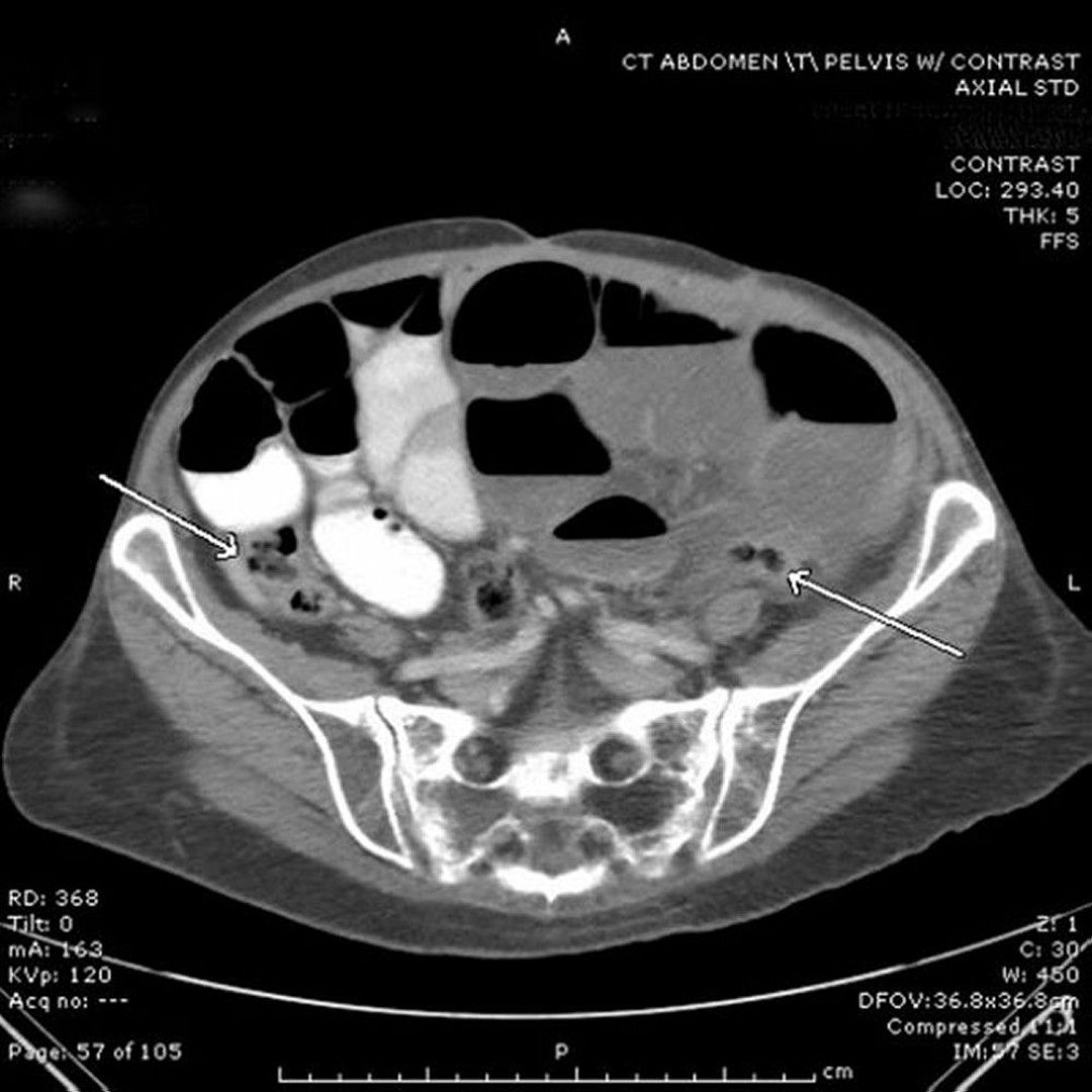 Image:Small-Bowel Obstruction (CT Scan)-Merck Manual Professional Edition