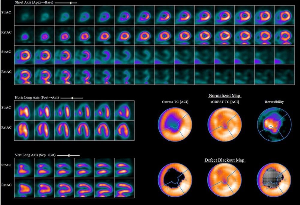 Cardiac Radionuclide Imaging - Cardiology - Merck Manual Professional ...