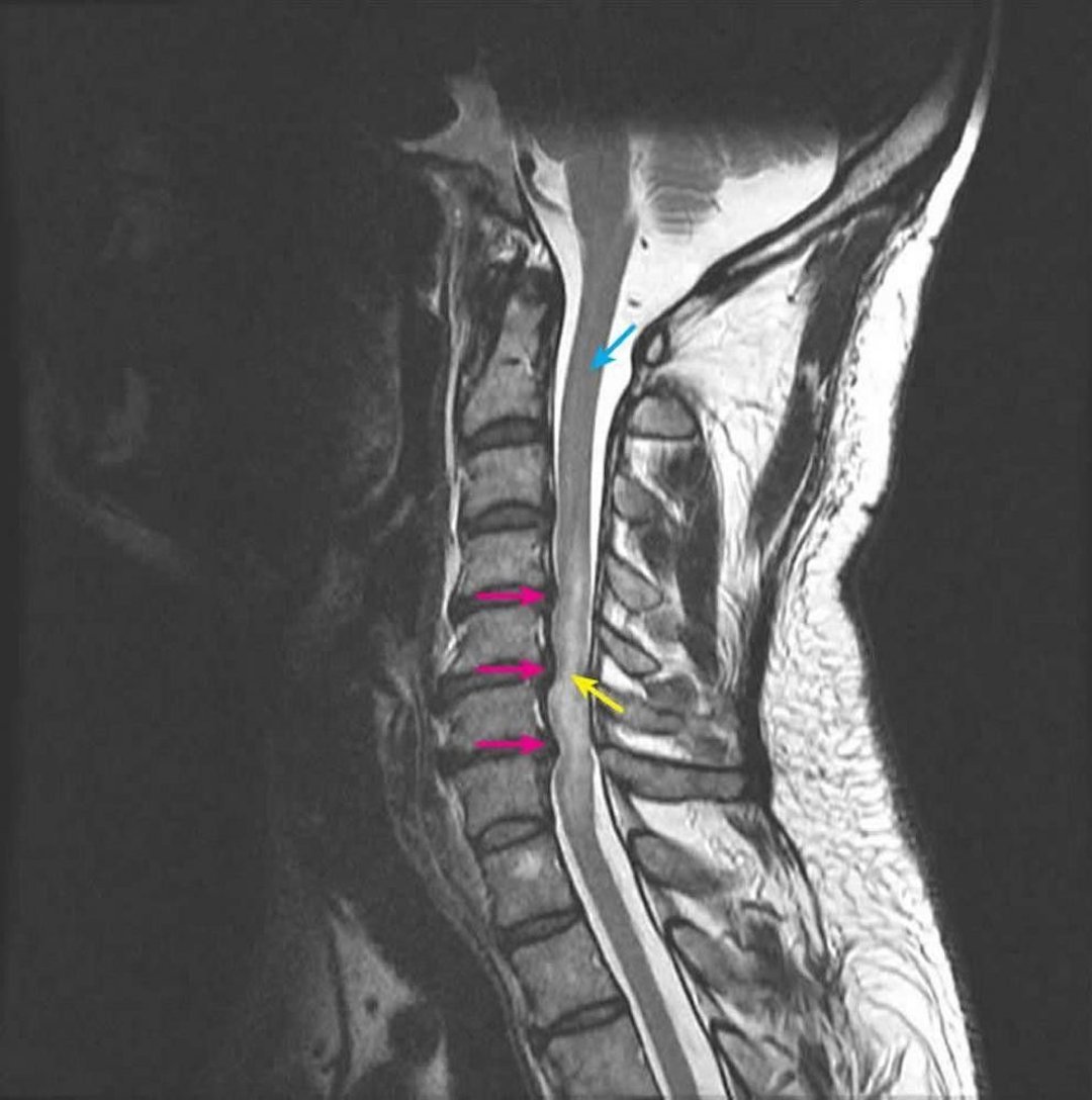 Image:Compressive Myelopathy-Merck Manual Professional Edition