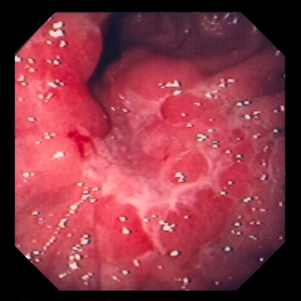 Stomach Cancer - Oncology - Merck Manual Professional Edition